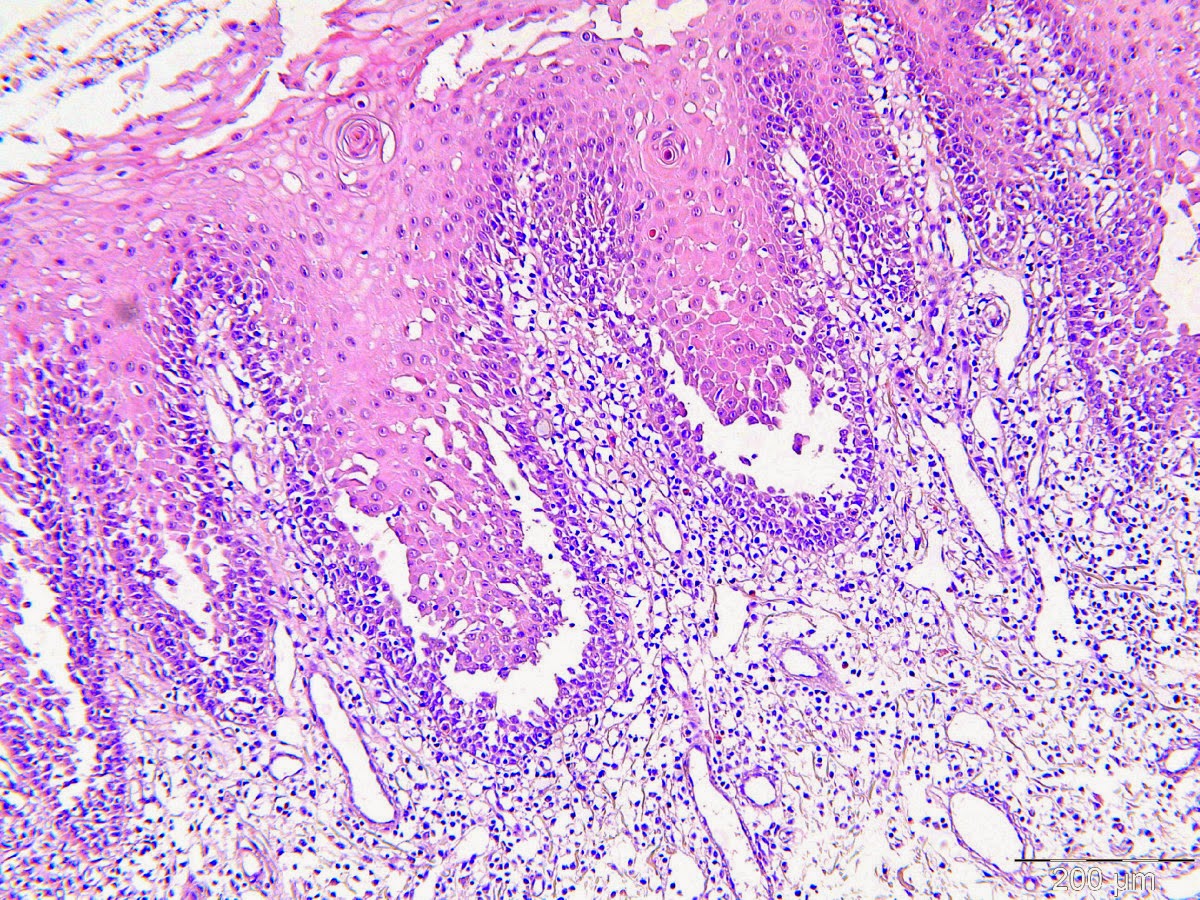 Pênfigo Vulgar | Estomatologia Online