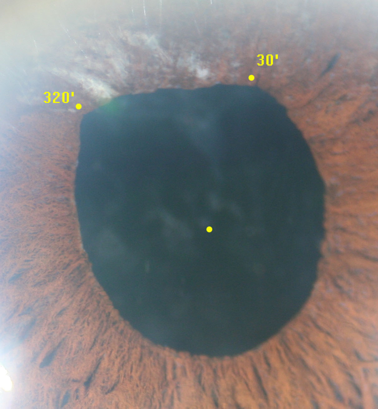 Modern & Multidimensional Iridology: Frontal Flattening & Right Ellipse ...