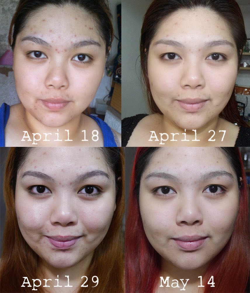 Royale Kojic Soap Before And After