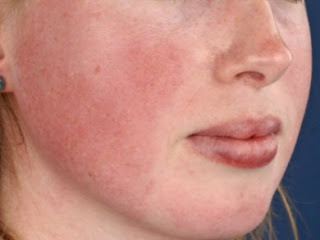 A positive outcome using Rhofade for alcohol flush :D : r/Rosacea
