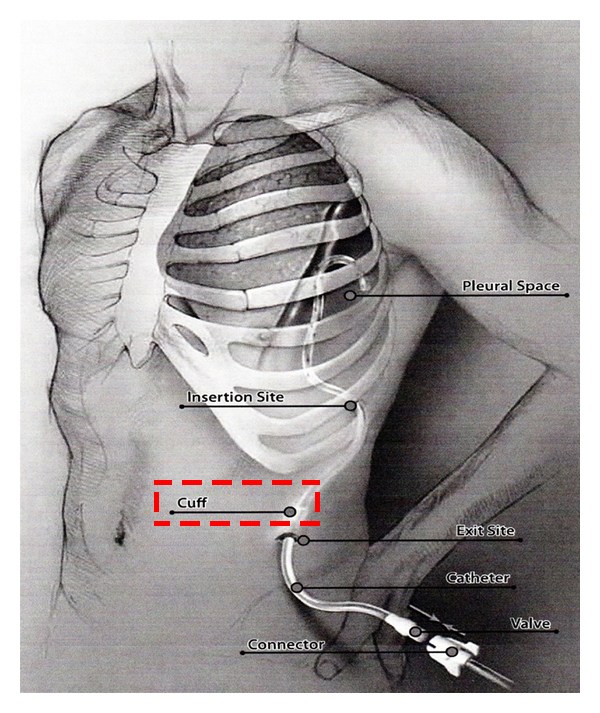 Cancer Continuum: My Diagnosis Story
