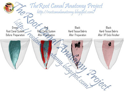 The Root Canal Anatomy Project: Hard Tissue Debris Removal: XP Endo ...
