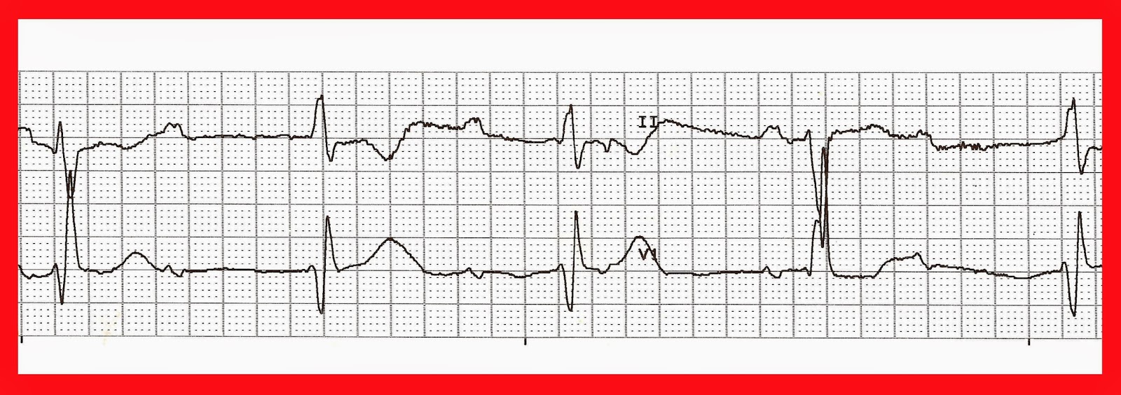 Basic EKG Rhythm Test 20