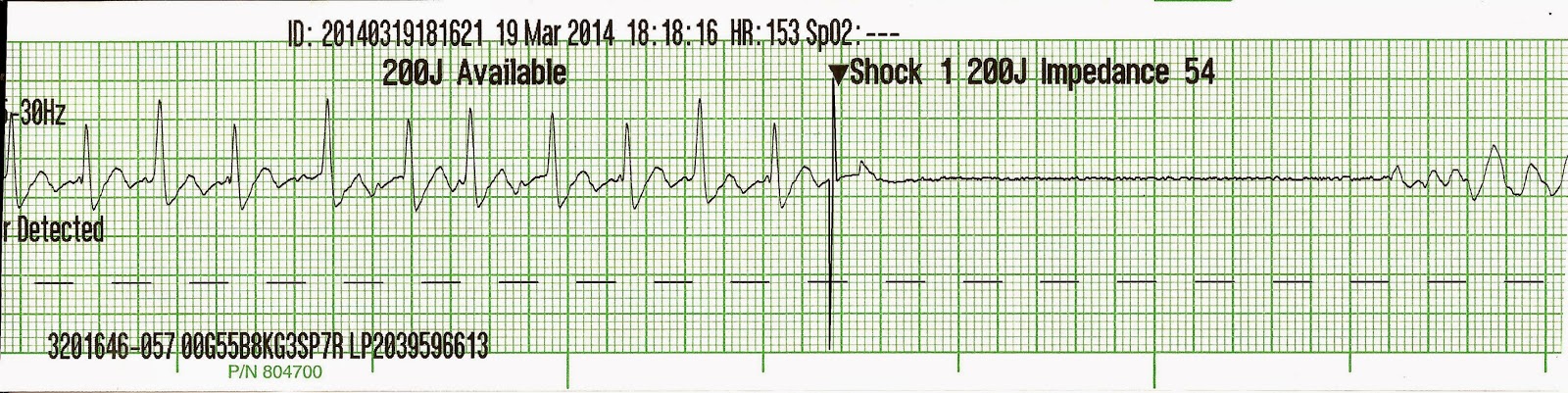 Practice EKG Strips 405