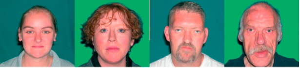 Acromegaly Bloggers: Faces of Acromegaly