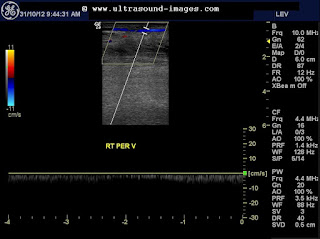 Deep-vein thrombosis- before and after treatment: ~ Ultrasound Cases Info
