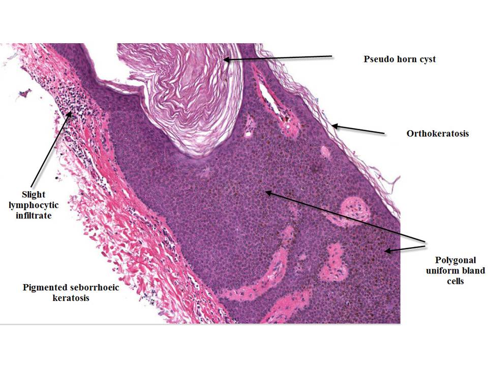 Dermpath Made Simple - Neoplastic: Seborrhoeic keratoses and Variants
