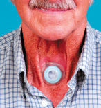 Doctors With Reiki: Laryngectomy