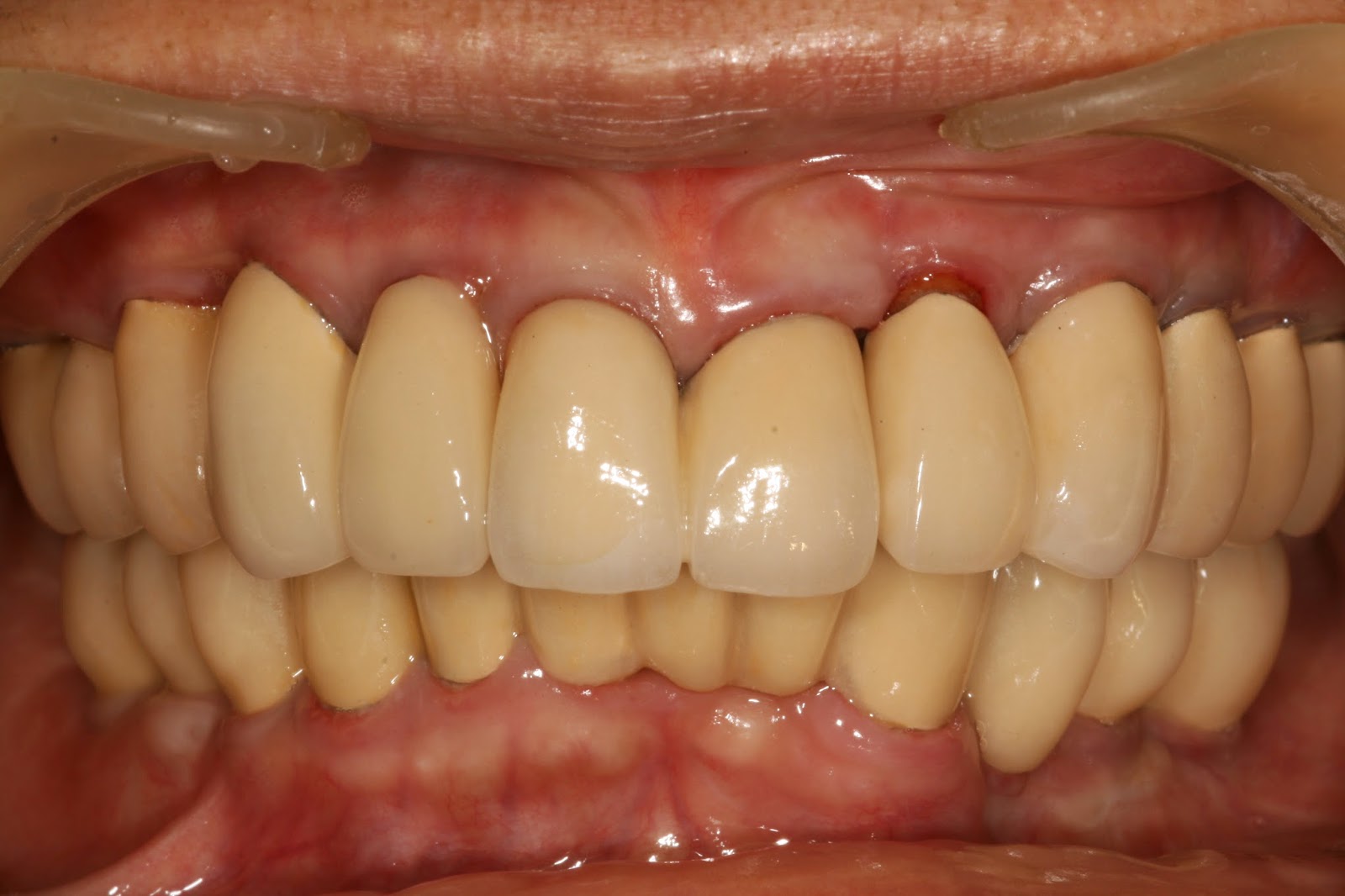 Jojoe79's Dental Clinic Record: root coverage, tunnel method, CTG