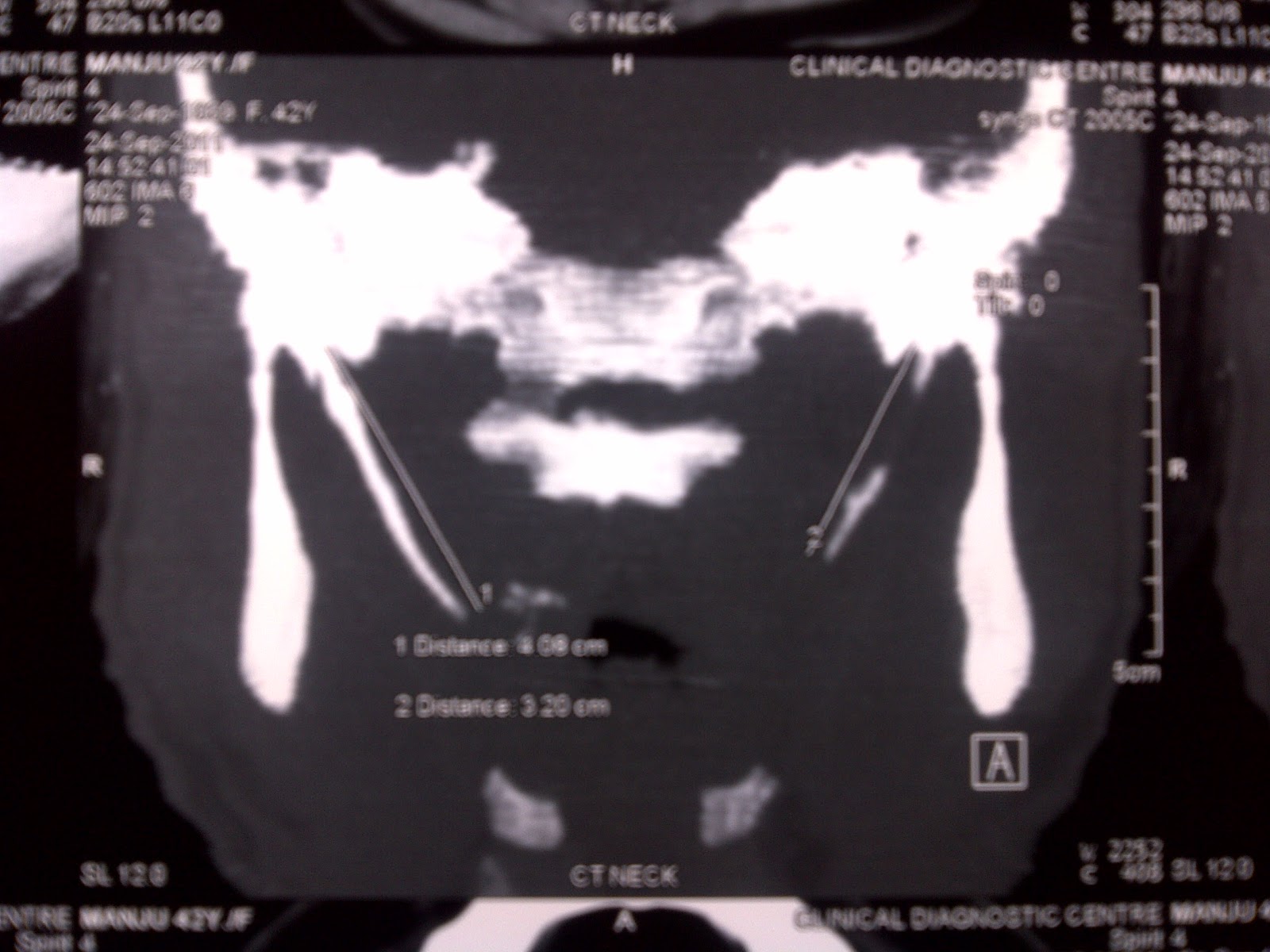ENT Surgeon's blog: Elongated Styloid Process Excision