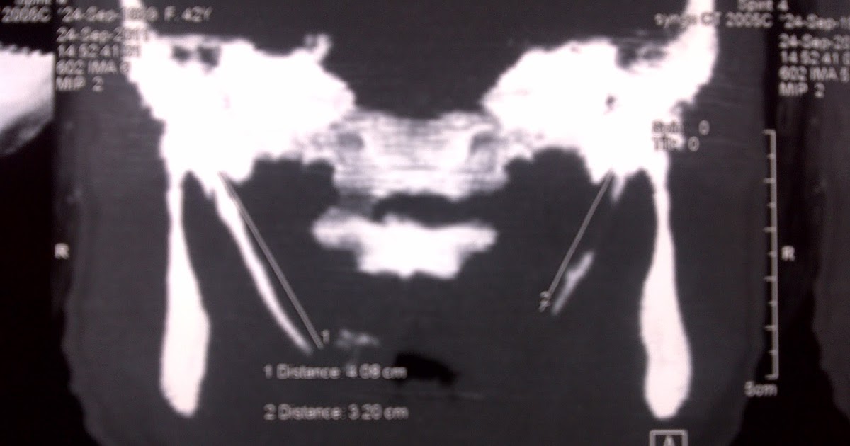 ENT Surgeon's blog: Elongated Styloid Process Excision
