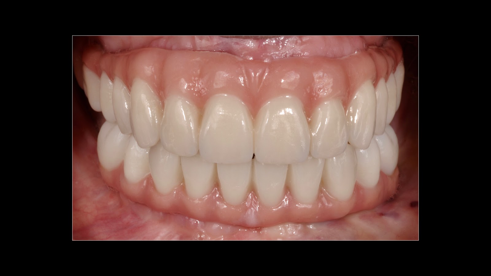 Víctor Vives: ZIRKONZAHN PRETTAU CAD CAM