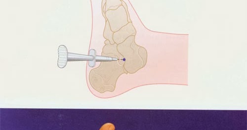 Subtalar Joint Injection ~ Nursing