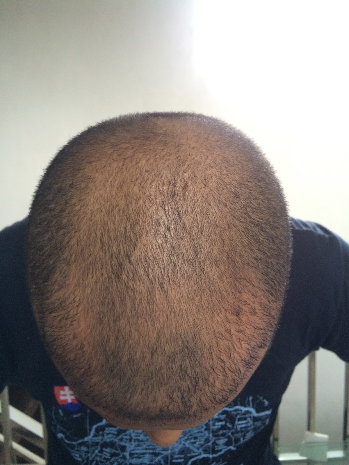 hair transplant experience - pengalaman transplantasi rambut / tanam rambut