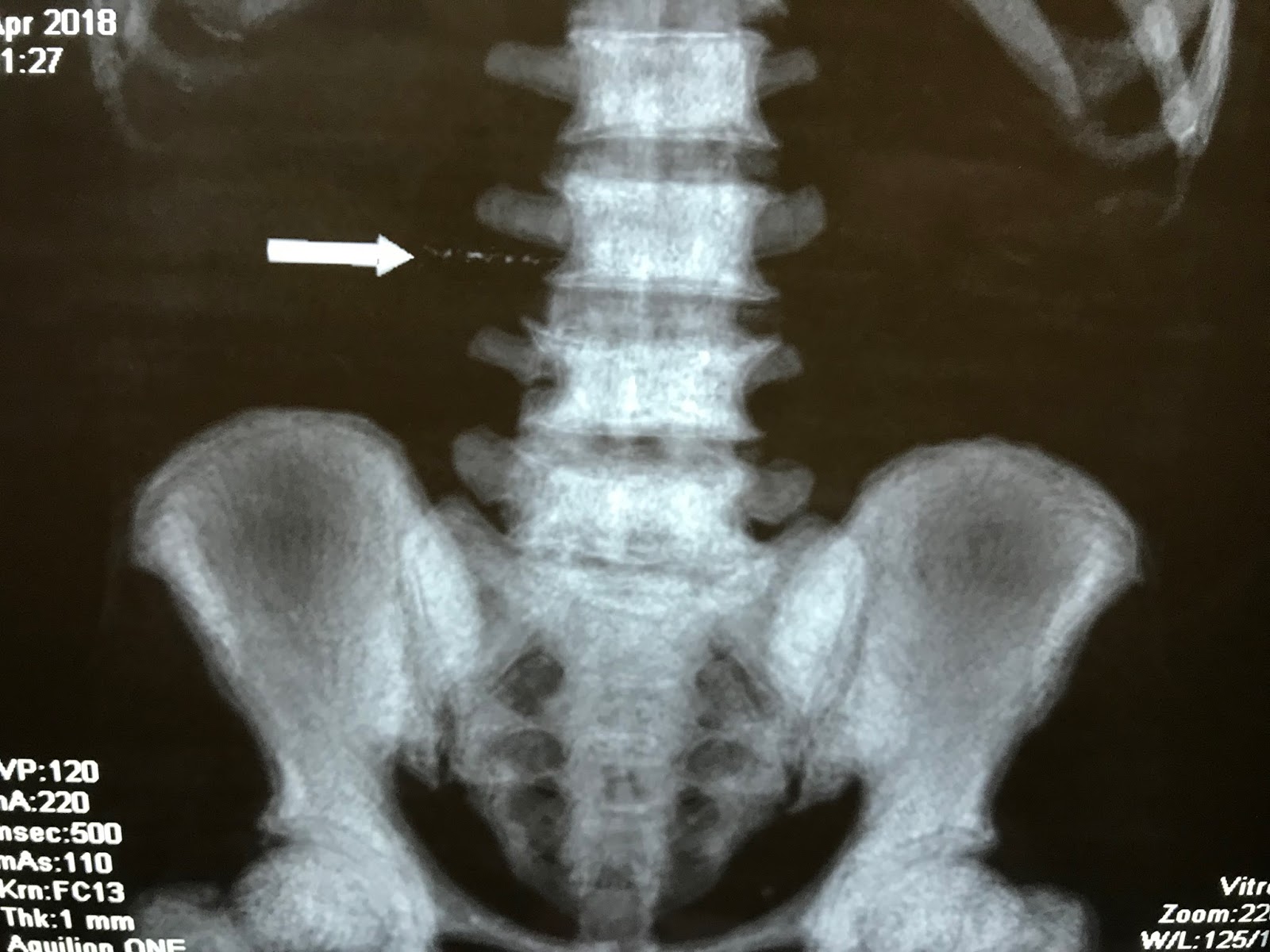 VIETNAMESE MEDIC ULTRASOUND: CASE 491: TOOTHPICK MOVING TO ...