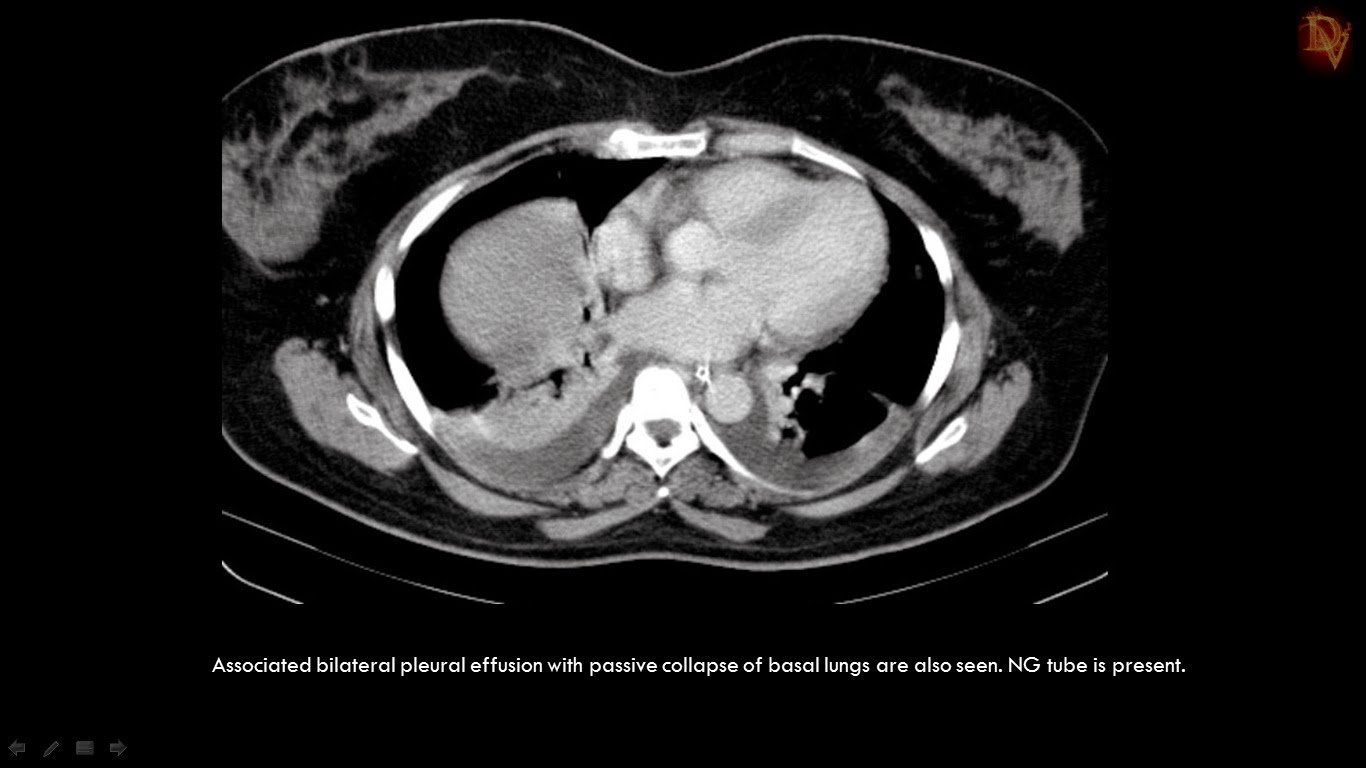 Ultimate Radiology Acute Necrotizing Pancreatitis
