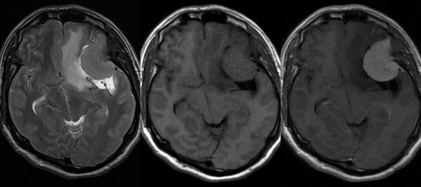 Meningioma Brain Tumor