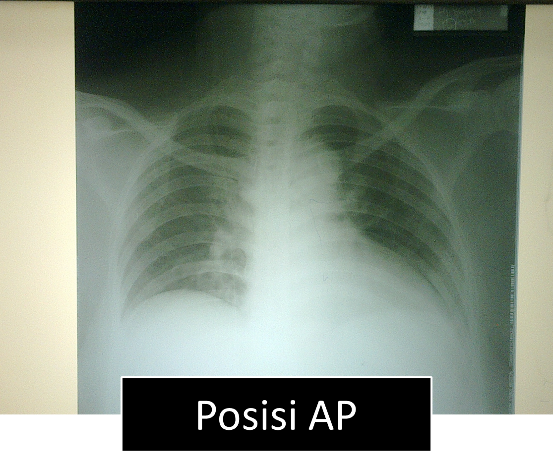 Creatio ex Nihillo: Cara Membaca Photo Roentgen Thorak