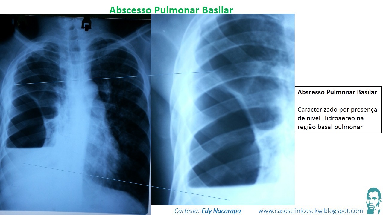 Casos Clinicos: Abscesso Pulmonar