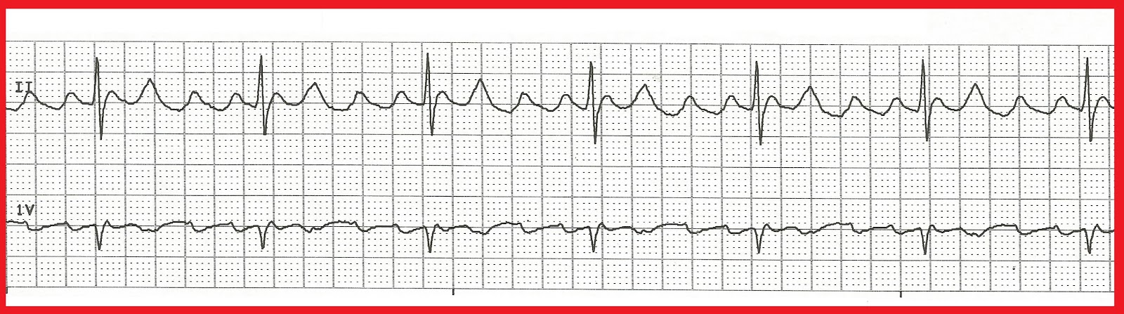 Practice EKG Rhythm Strips 184