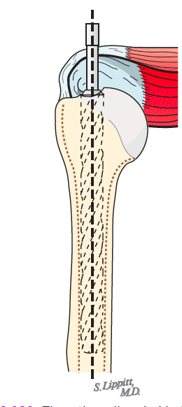 UW Shoulder and Elbow Academy: Humeral head osteotomy in shoulder ...