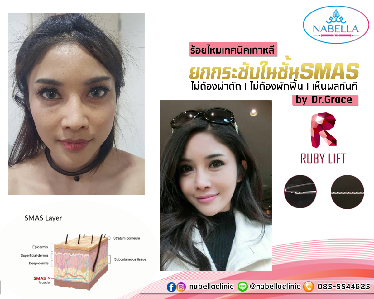 NaBella Clinic By NaBell: แนะนำ!!! ร้อยไหม SMAS LOCK คืออะไร ดีอย่างไร???