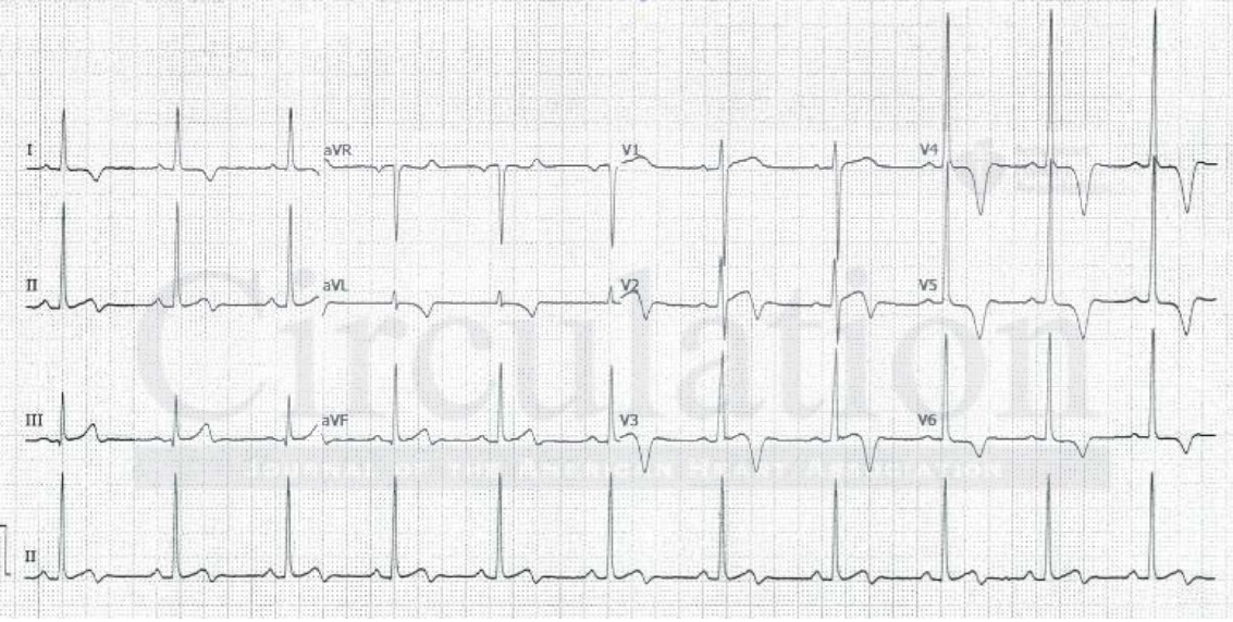 Dr. Smith's ECG Blog: 15 yo AAM with ST Elevation and T-wave Inversion ...