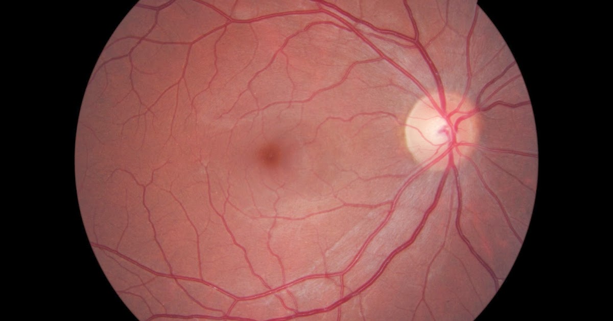 Eyedolatry: The Patient's Guide to Optic Nerve Drusen