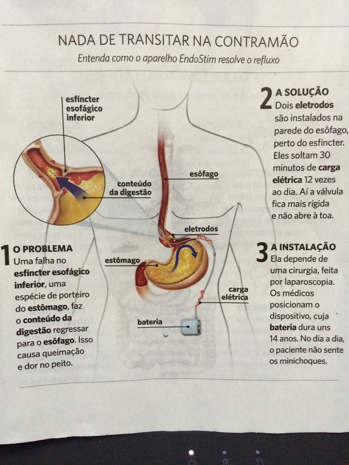 Blog Dr. Carlos: Marca-passo para o tratamento do Refluxo Gastro-Esofágico