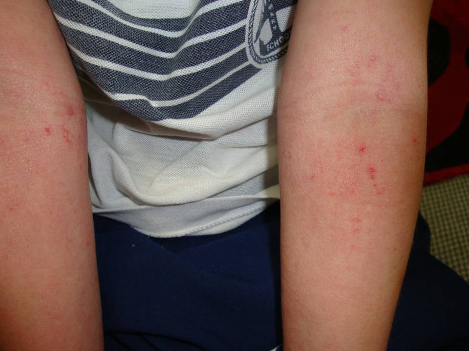 Consultations in Dermatology: The Rash that itches - Atopic Dermatitis