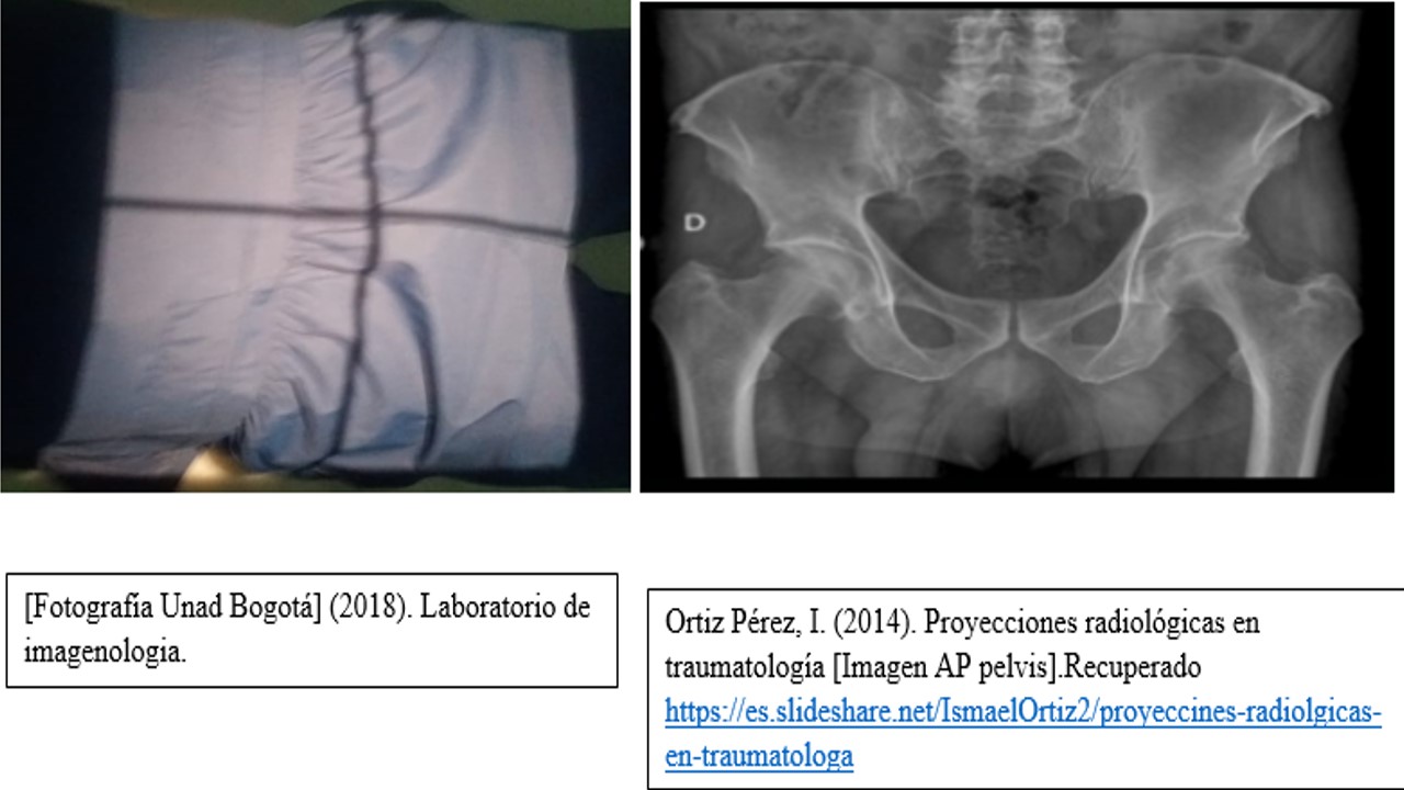 Cadera y Pelvis