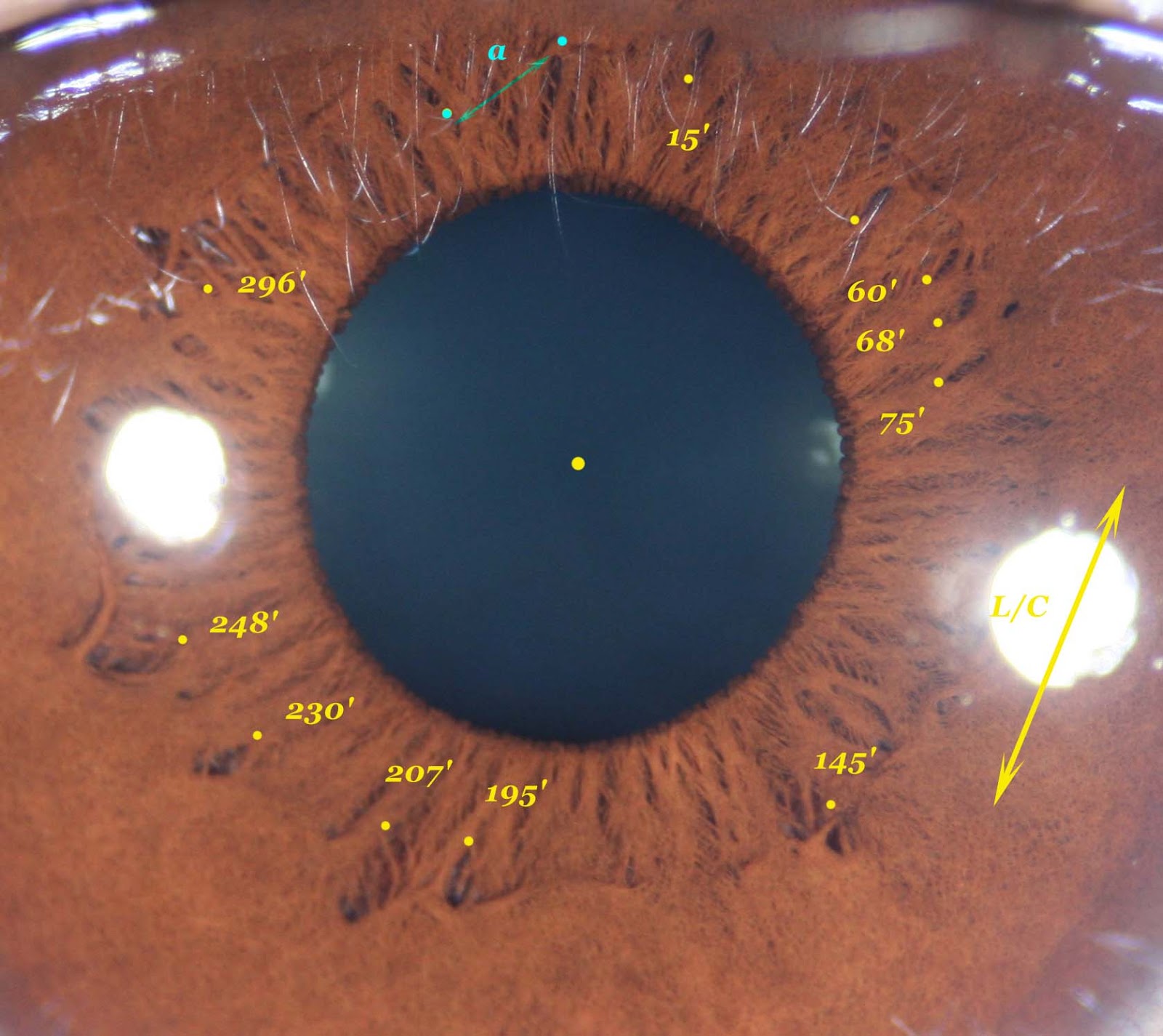 Modern & Multidimensional Iridology: Crypts, Internal Lacunae ...