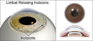Limbal+Relaxing+Incisions.jpg