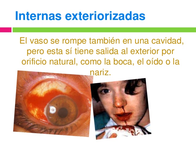 HEMORRAGIAS Y SUS TIPOS: HEMORRAGIAS Y SUS TIPOS