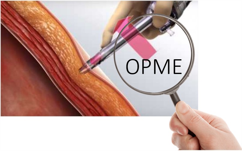 Rastreabilidade de OPME (órtese, prótese e materiais especiais) - DMI ...