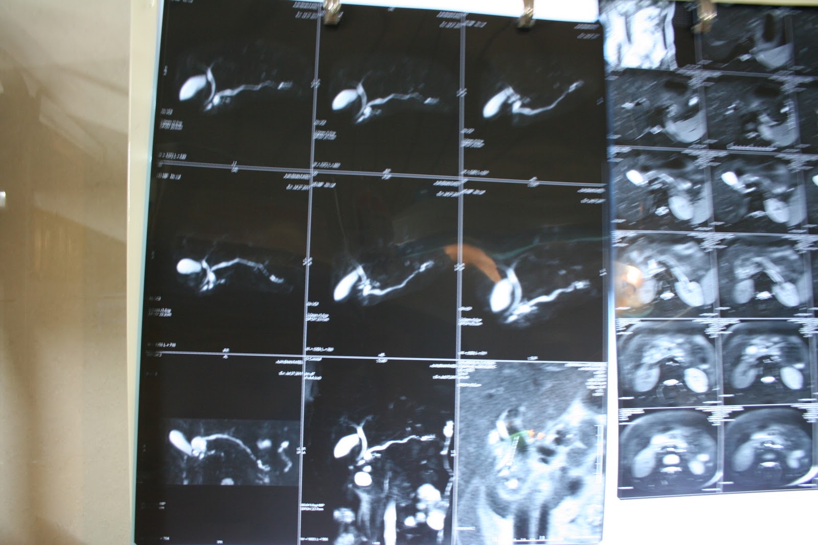 Dr Rahul Naik's Blog on Gastroenterology, GI, Laparoscopic and ...