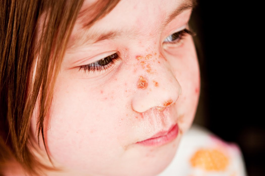 Happenings at Home: Strep Face