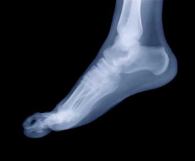 Foot Problems and Foot Pain: Extra Foot Bones, What is it?