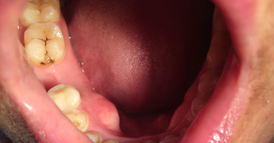 ENT Surgeon's blog: Mandibular Tori