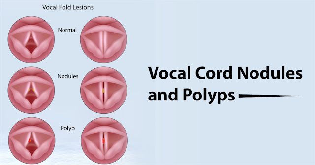 Vocal Cord Cysts and Polyps ~ Vikram ENT Hospital & Research Institute