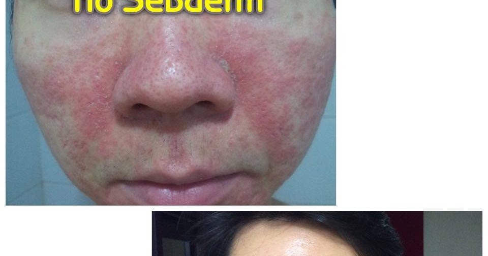 ผิวติดสเตียรอยด์กับเชื้อรา - Seb derm เป็นเซ็บเดิร์ม สิวเรื้อรังมา 20 ปี