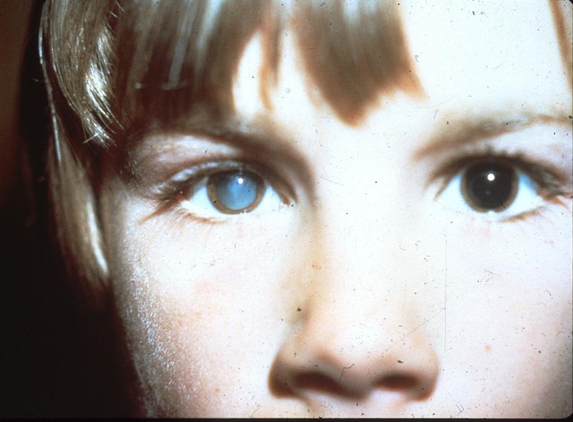 Parasitophilia: Toxocara canis