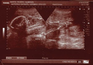 Diccionario de Epónimos: signo de Spalding y Spangler