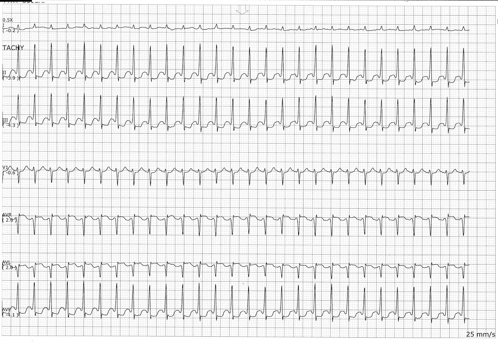 Supraventricular tachycardia