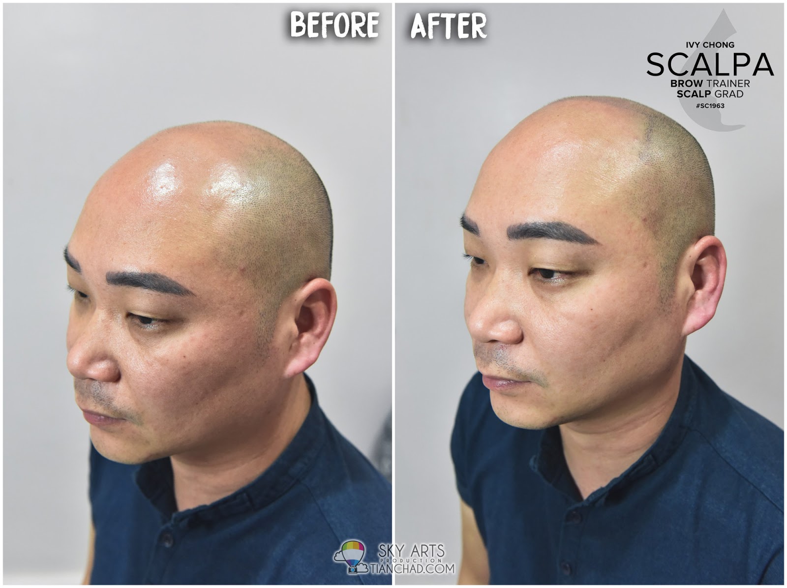 Best Scalp Micropigmentation (SMP) in Malaysia | SMP 让你不再为秃头而烦恼