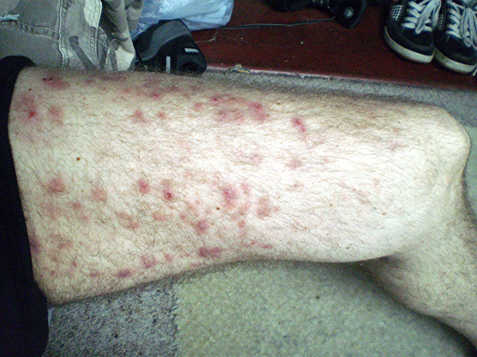 Life with HIV: Ongoing pain management