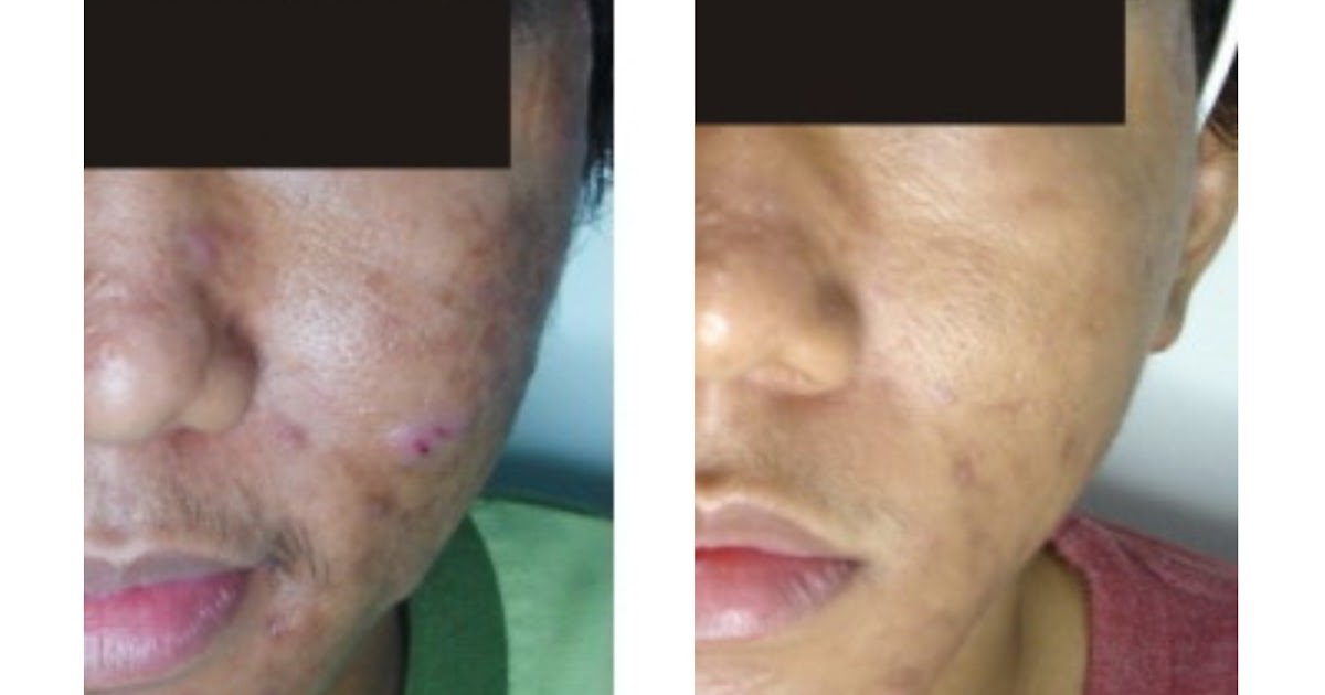 Combating Acne: Combating Acne with Blue Light
