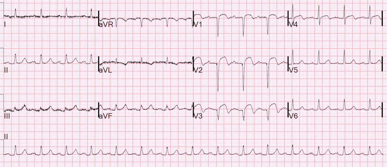 Lv Aneurysm Ekg | IUCN Water