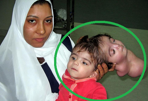 Baby born with two heads, the other head was able to... - Things you ...