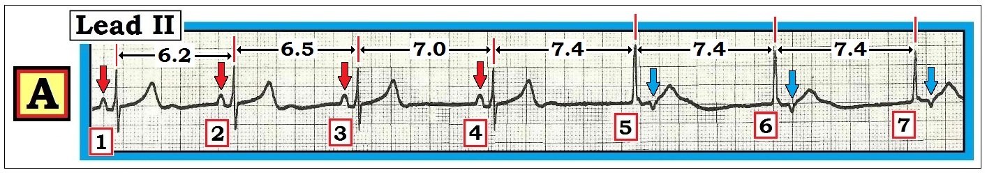 ECG Interpretation: ECG Blog #64 — AV Block and/or Escape beats?